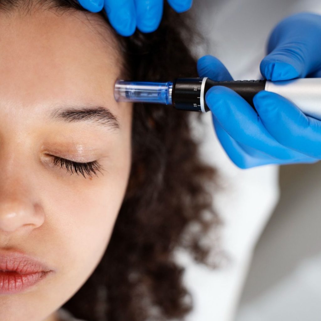 Glow Your Skin In Summer With Microneedling Treatment