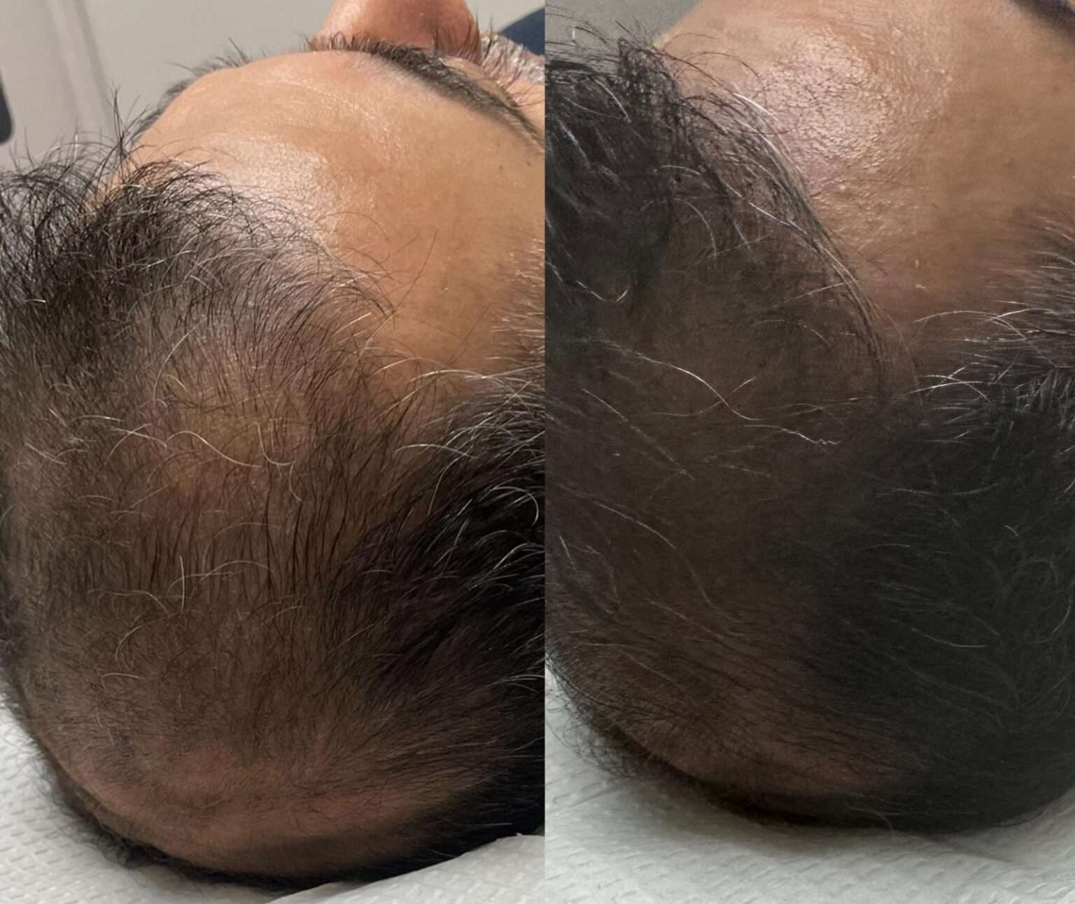 PRP for Men NYC – Hair Loss & Skin Treatment in Forest Hills